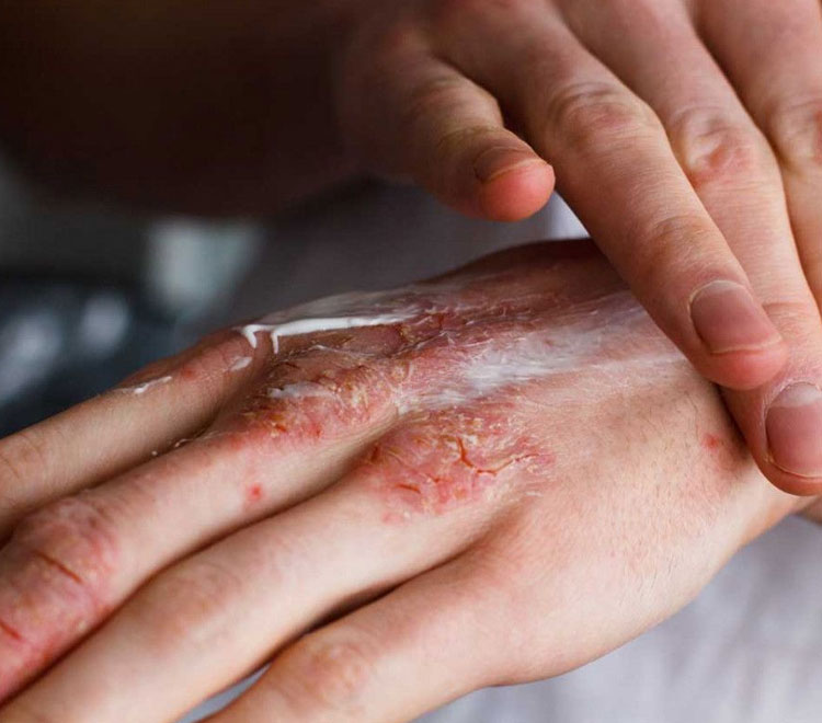 Psoriasis : symptômes, causes et traitements de cette maladie